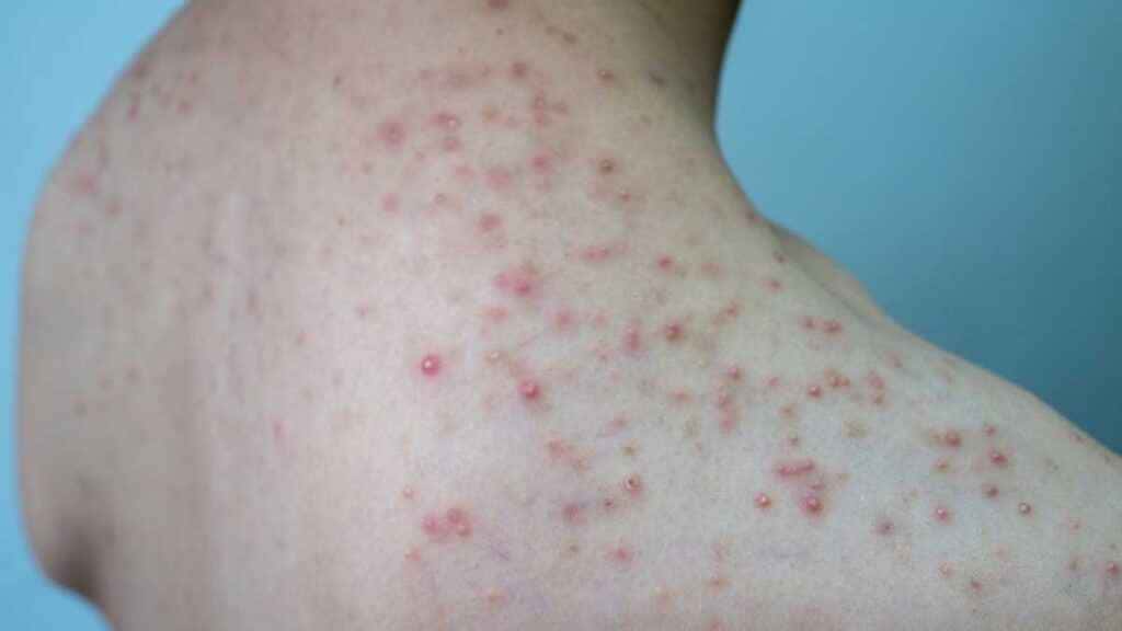 Foliculite Decalvante Tem Cura: O Que Você Precisa Saber